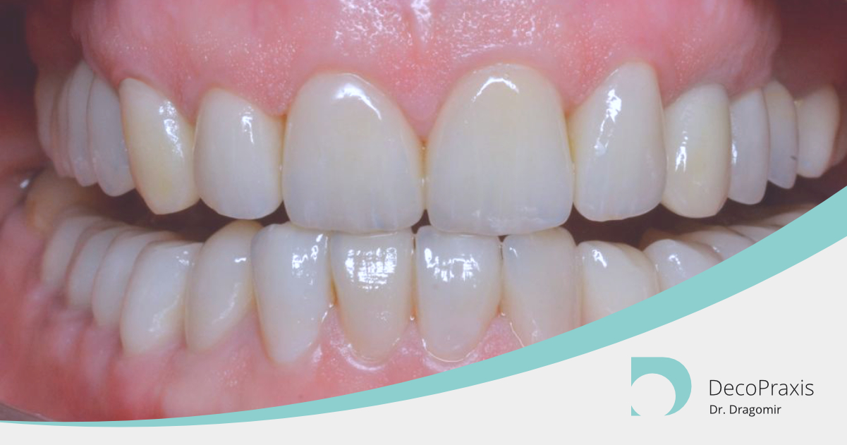 Oral rehabilitation - Exceptional results - DecoPraxis - Dr. Dragomir